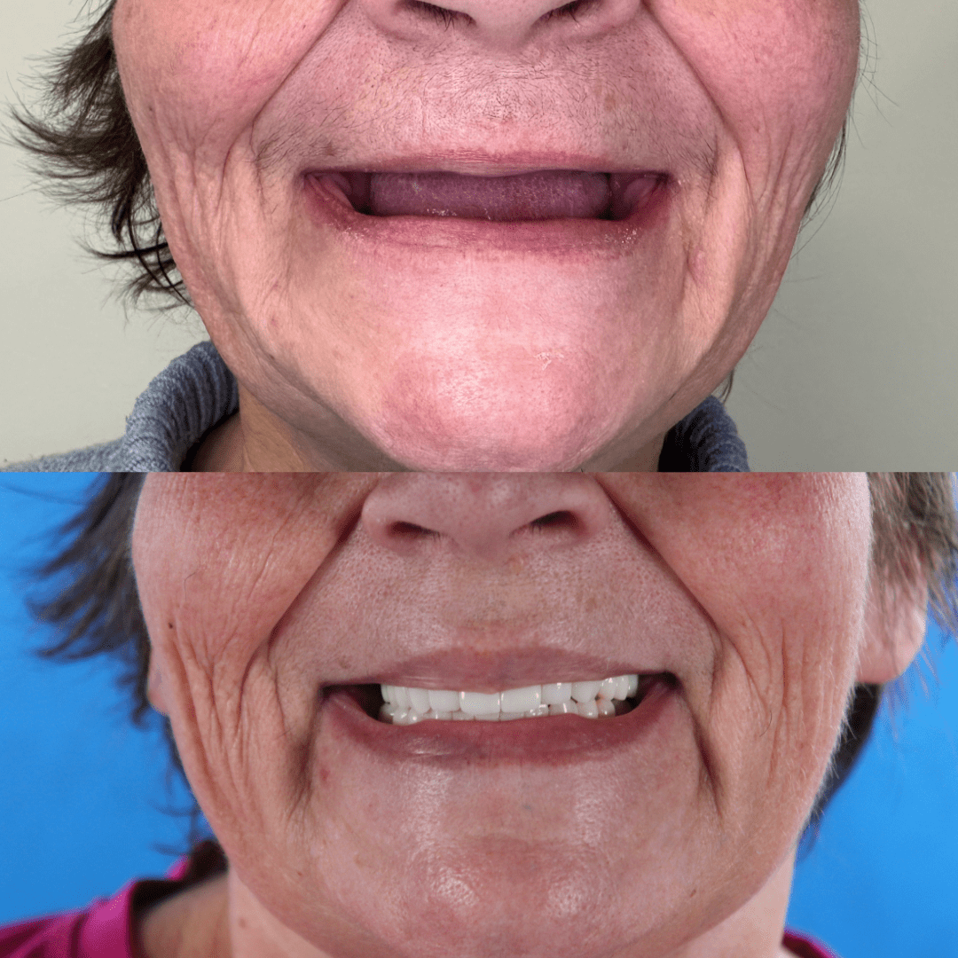 Dental Implants | Full Jaw Implants | (08) 8231 2609