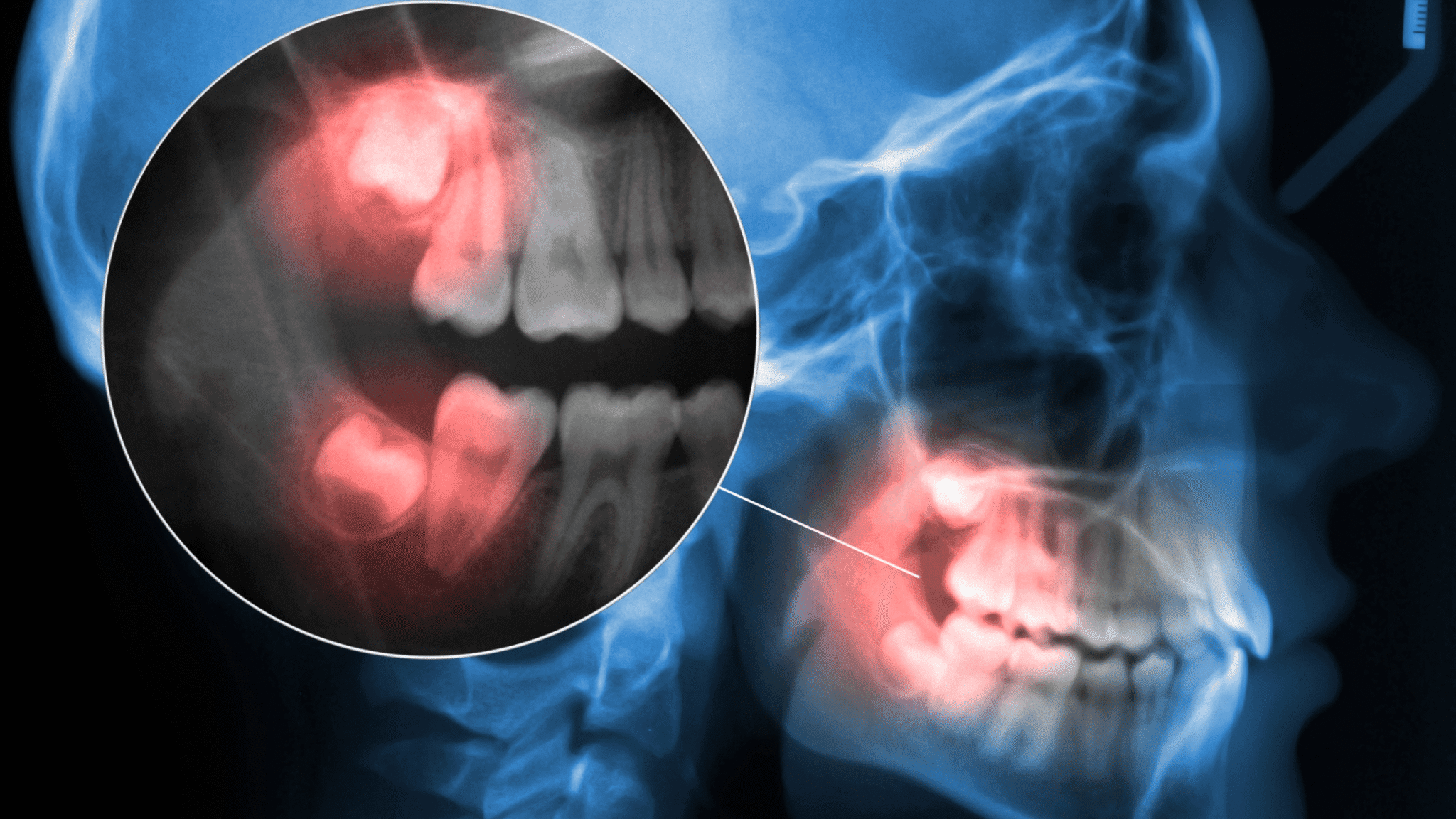 Tooth Extraction Cost Australia | Wisdom Teeth Removal & Dental Care